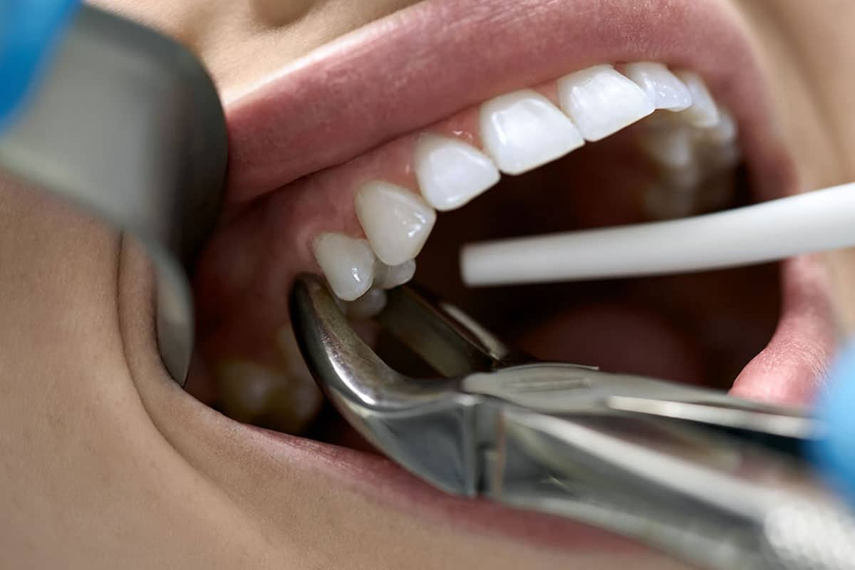 Tooth extraction and wisdom tooth extraction in Dubai